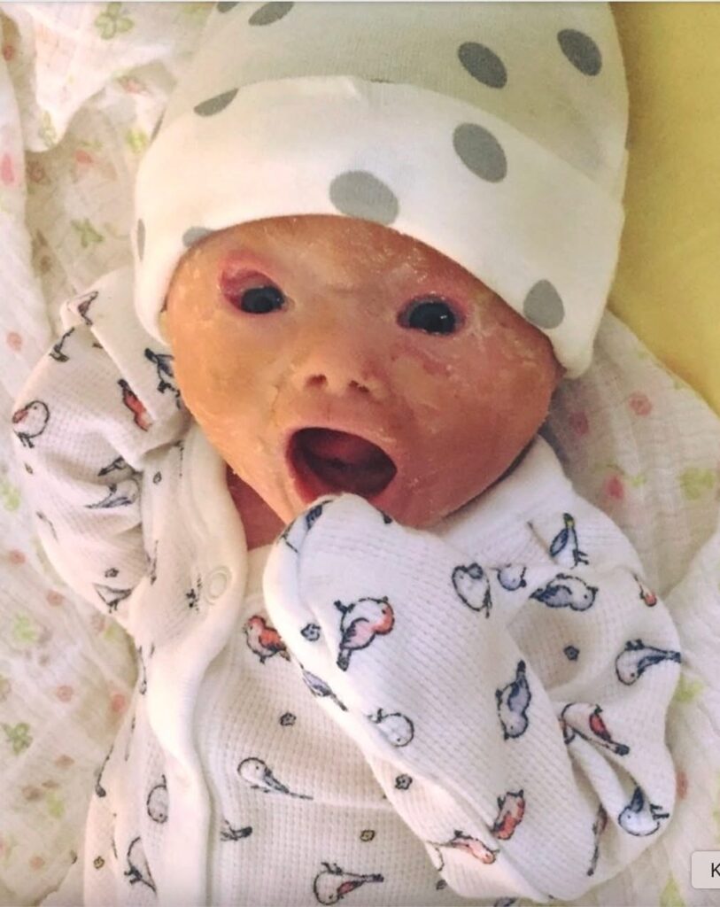 My baby’s skin hardened & split seconds after birt – but she isn’t any ...